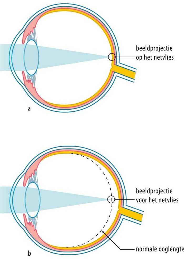 Myopie Management - Opticien van den Bergh