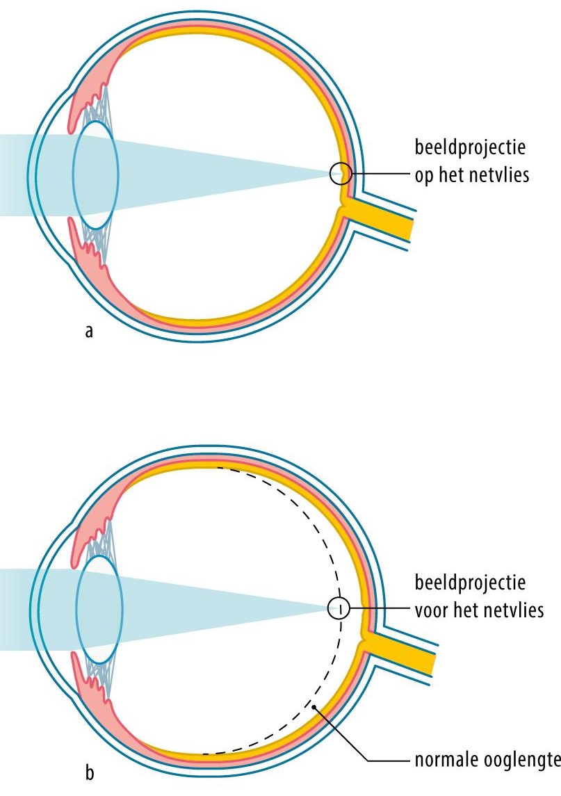 Myopie Management - Opticien van den Bergh